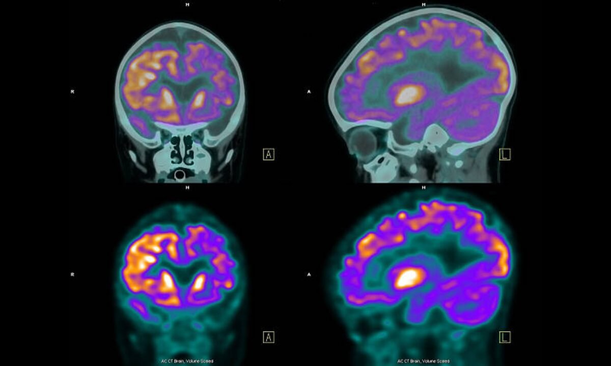 Understanding PET CT scan: Process, Diagnosis and Results