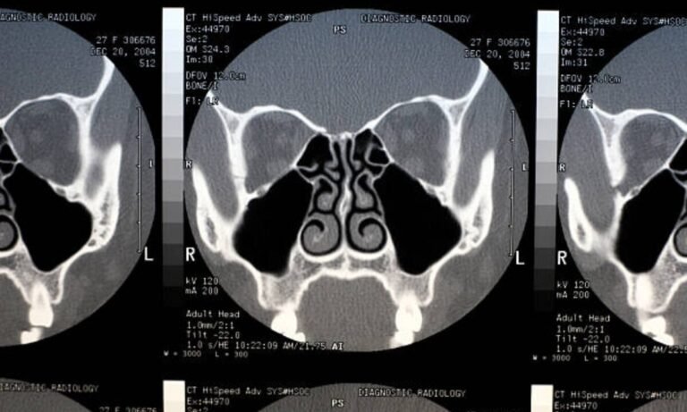 Understanding Sinus CT Scan: Process, Benefits, and More